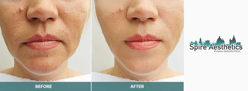 Before & After Cryolipolysis - Spire Aesthetics Coatbridge